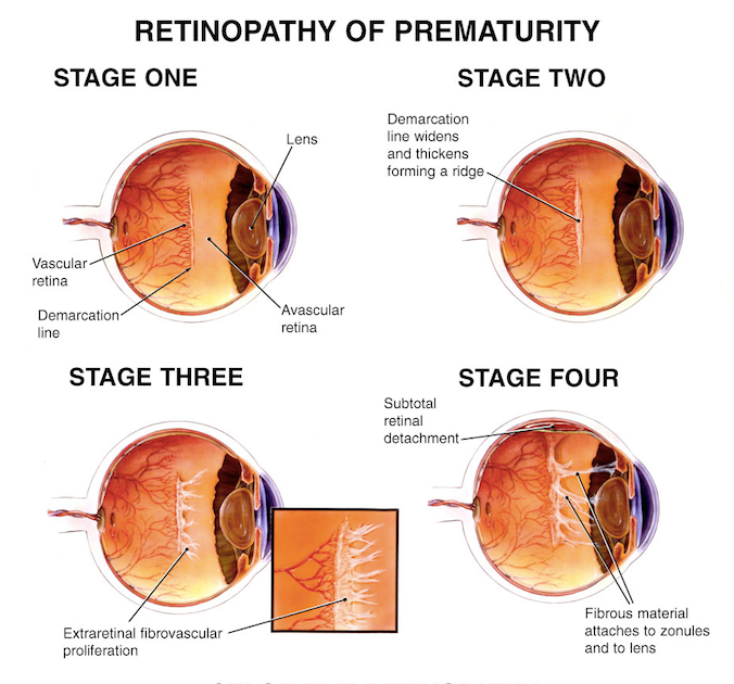 Retinopathy Of Prematurity Stemcellreferencestemcellreference Retinopathy Of Prematurity Stemcellreferencestemcellreference