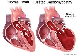 Dilated Cardiomyopathy - stemcellreferencestemcellreference