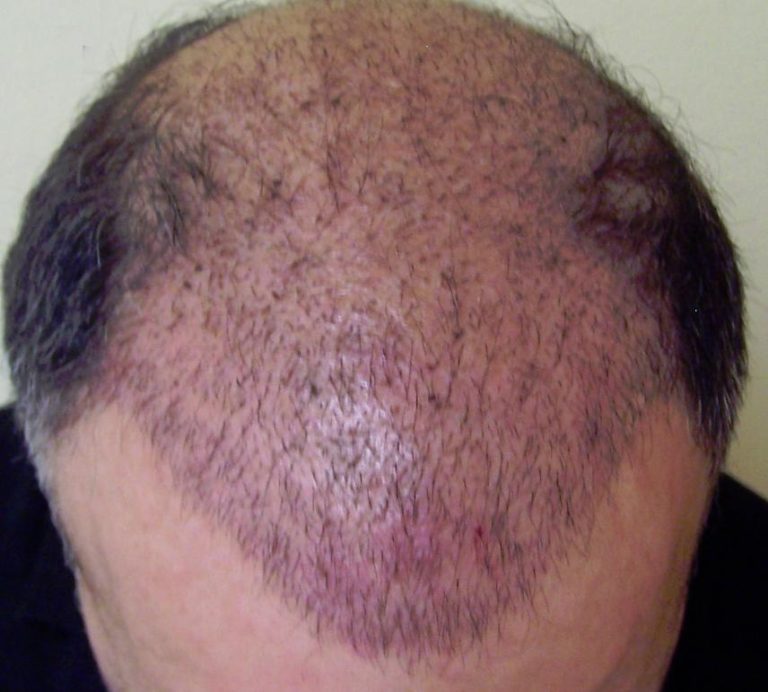 Hair Restoration - stemcellreference