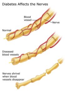Diabetic Neuropathy - stemcellreference