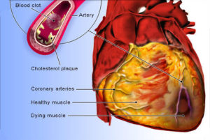 Ischemic Cardiomyopathy - stemcellreference